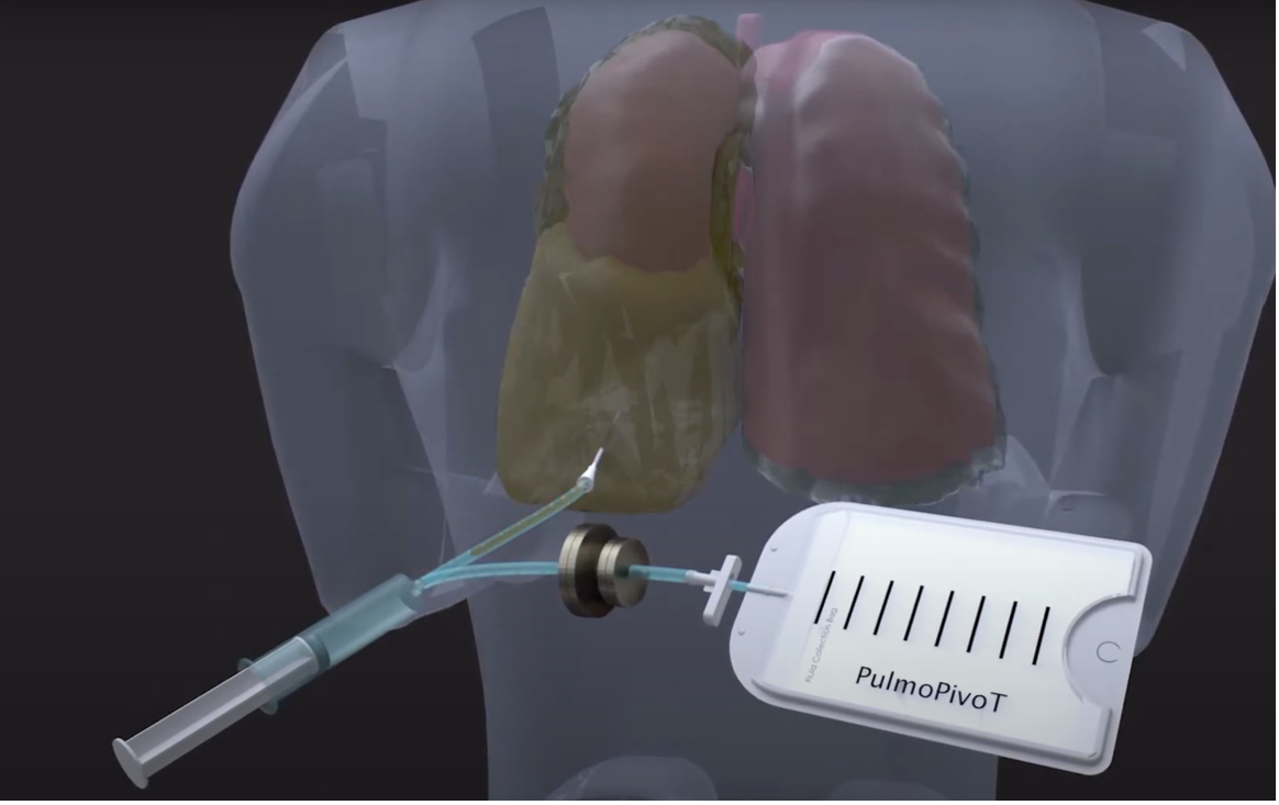 A device to improve the diagnostic success of thoracentesis procedures ...